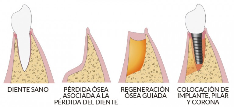 Regeneración ósea vertical